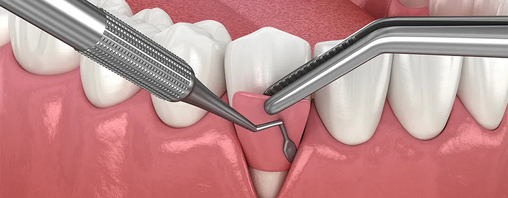 LANAP vs Traditional Gum Surgery | Understanding the Difference